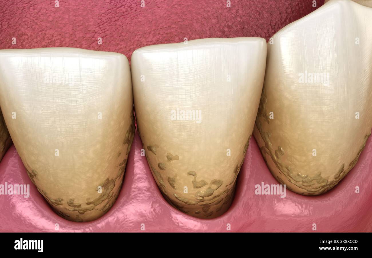 Tartar and bactrail tooth plaque, lower jaw. Medically accurate 3D ...