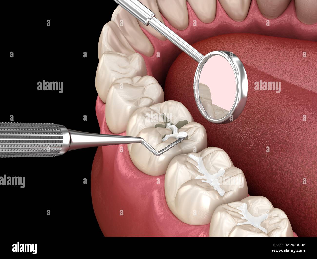 Molar tooth fissure restoration with filling. Medically accurate tooth ...