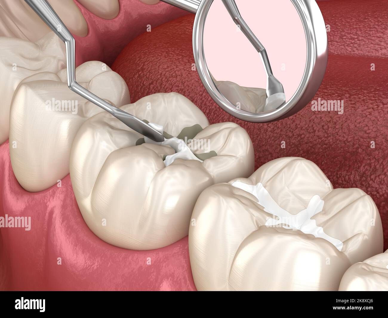 Molar tooth fissure restoration with filling. Medically accurate tooth ...