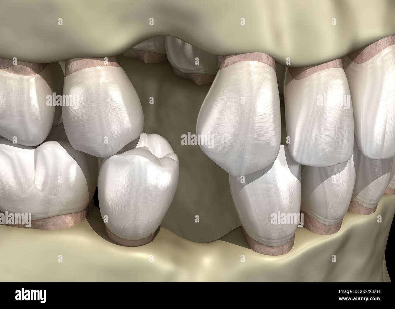 Teeth shift deformatiuon after losing teeth. 3D illustration of Popov ...
