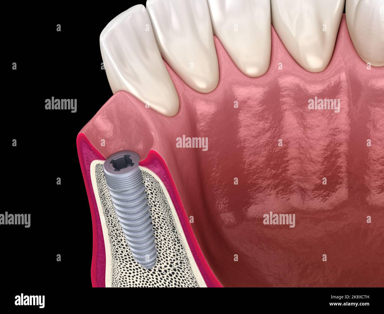 Instaled dental implantat. Medically accurate tooth 3D illustration ...