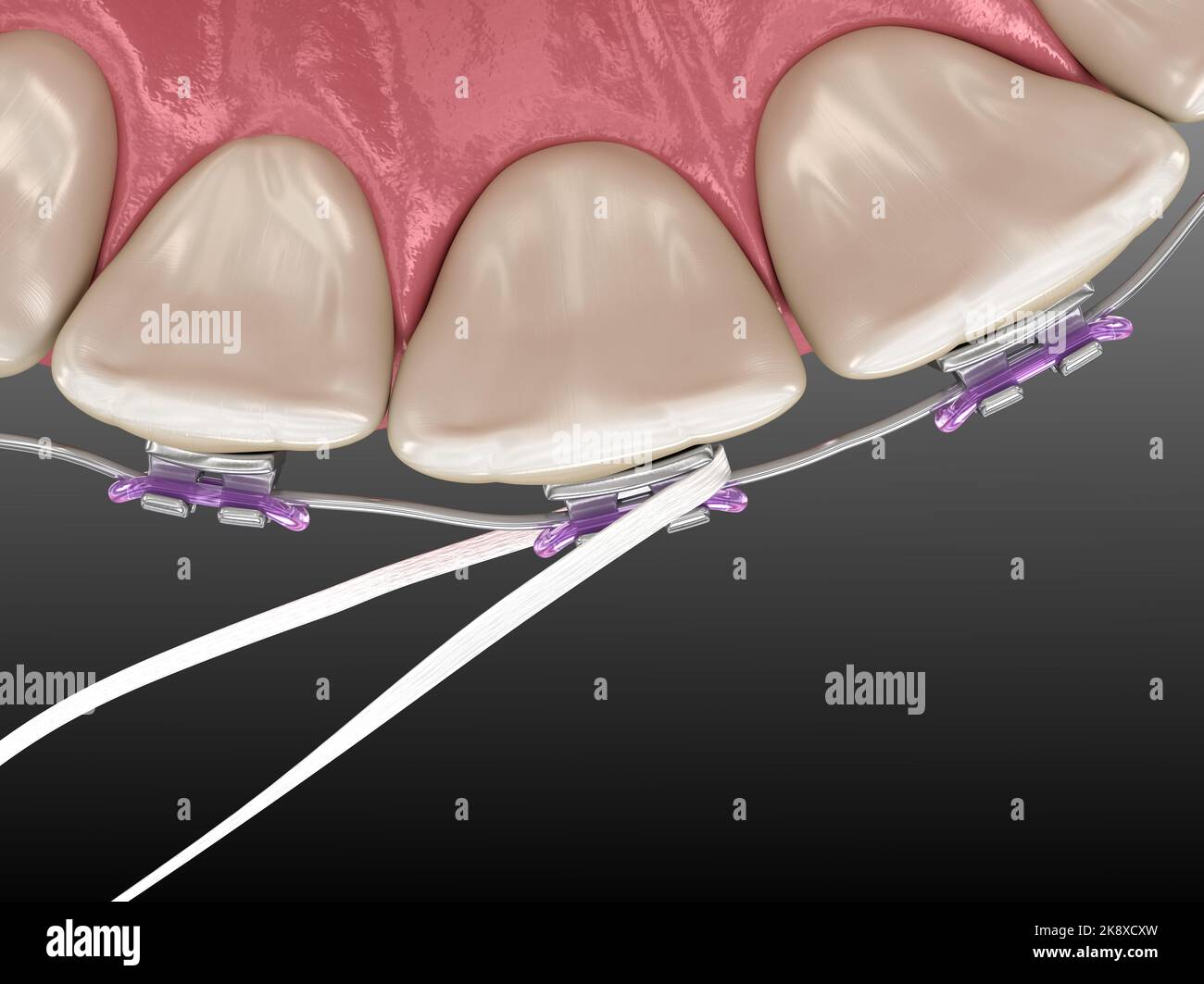 Dental Floss Cleaning Braces Process Medically Accurate 3d Illustration Of Oral Hygiene Stock