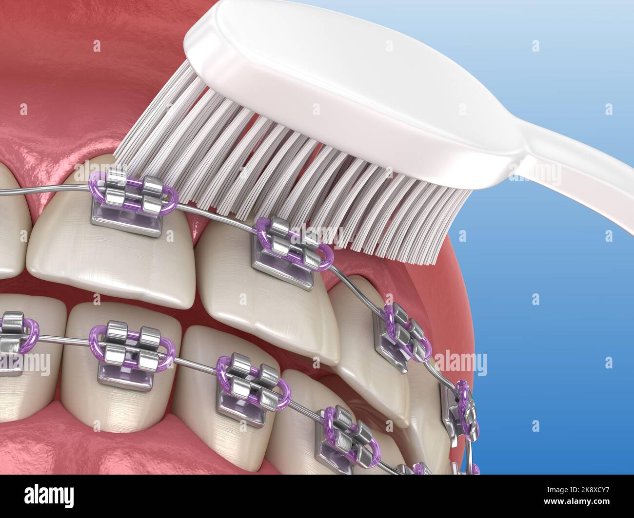 Toothbrush cleaning braces process. Medically accurate 3D illustration ...
