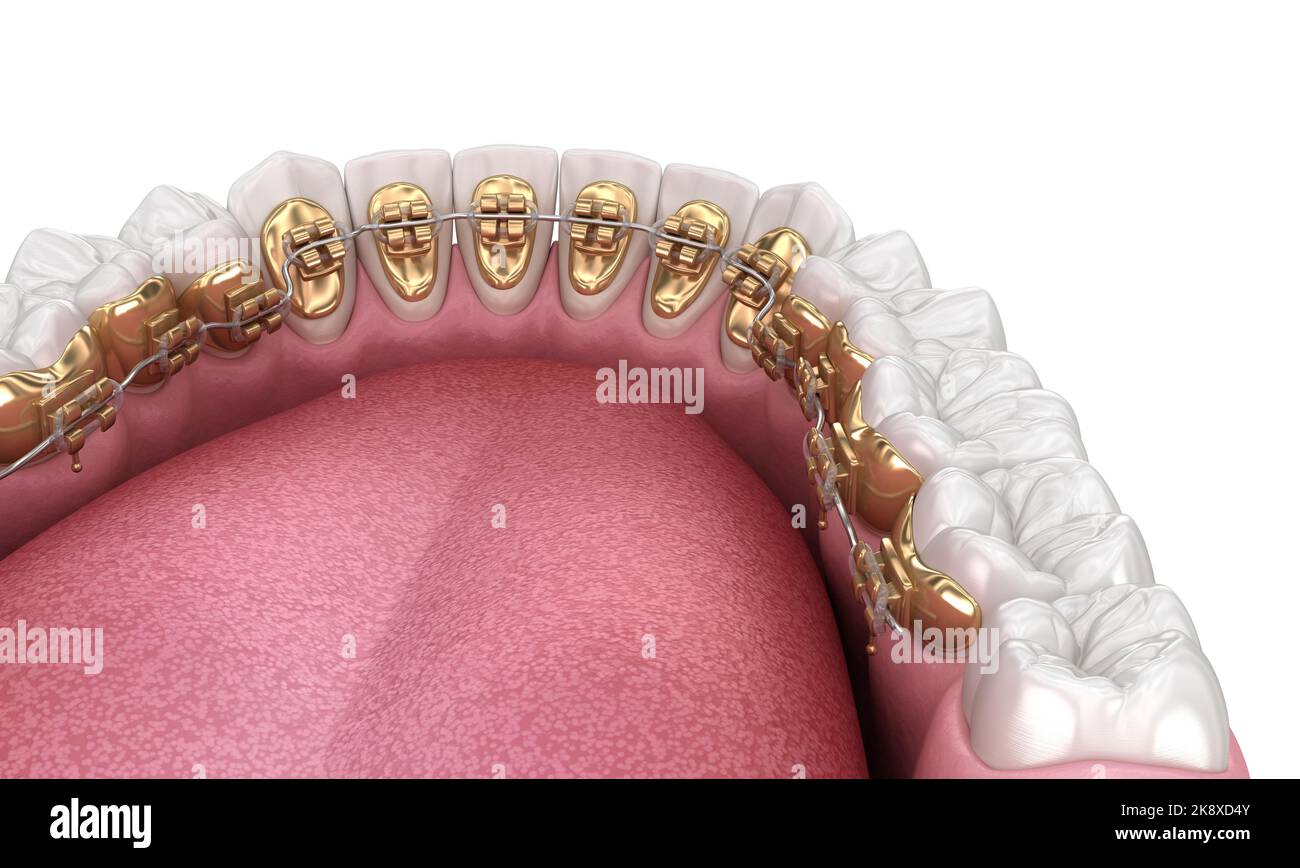 Healthy Teeth with gold braces, white teeth concept, dental 3D ...