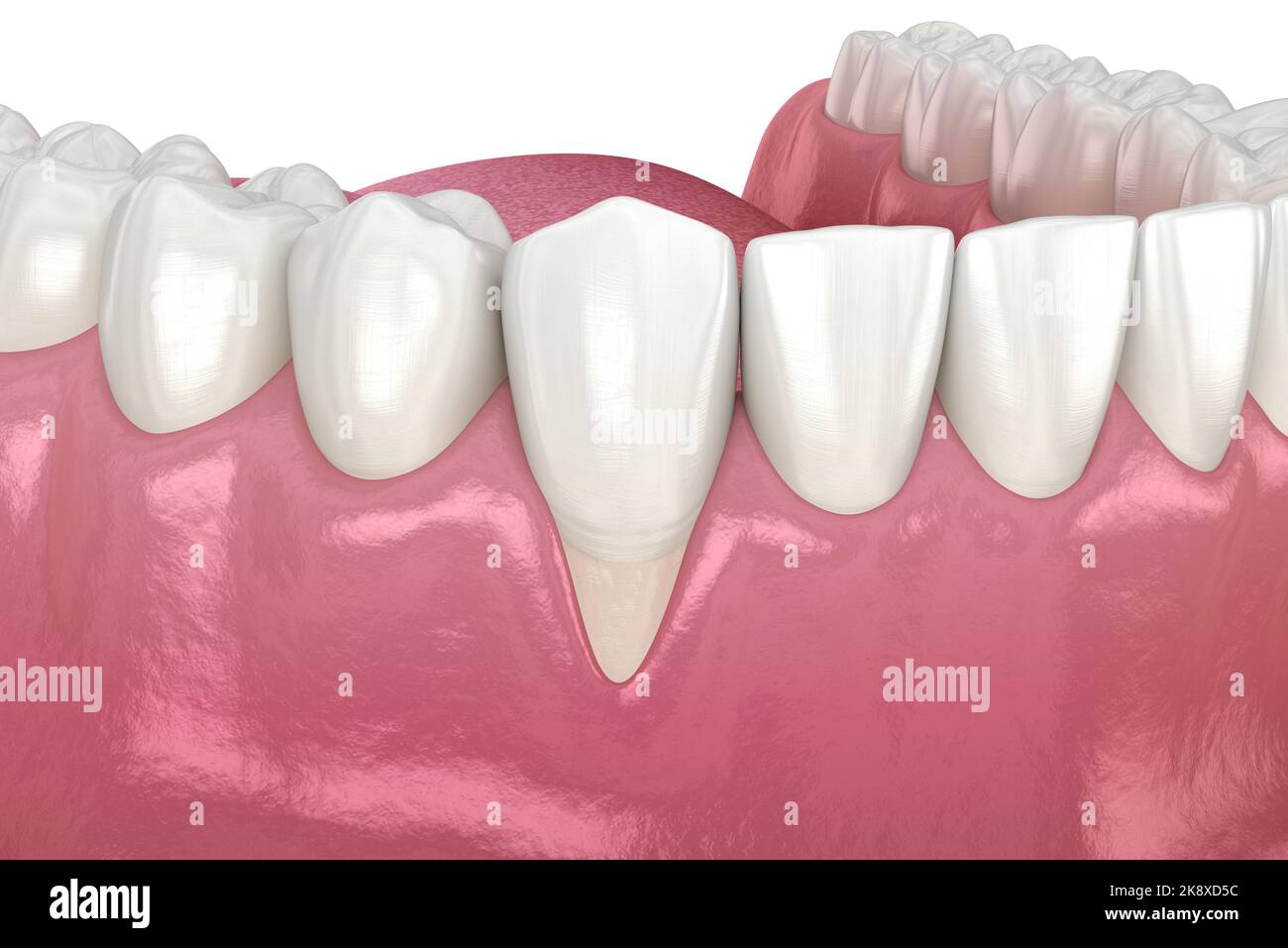 Gum Recession. 3D illustration of Dental problem Stock Photo - Alamy