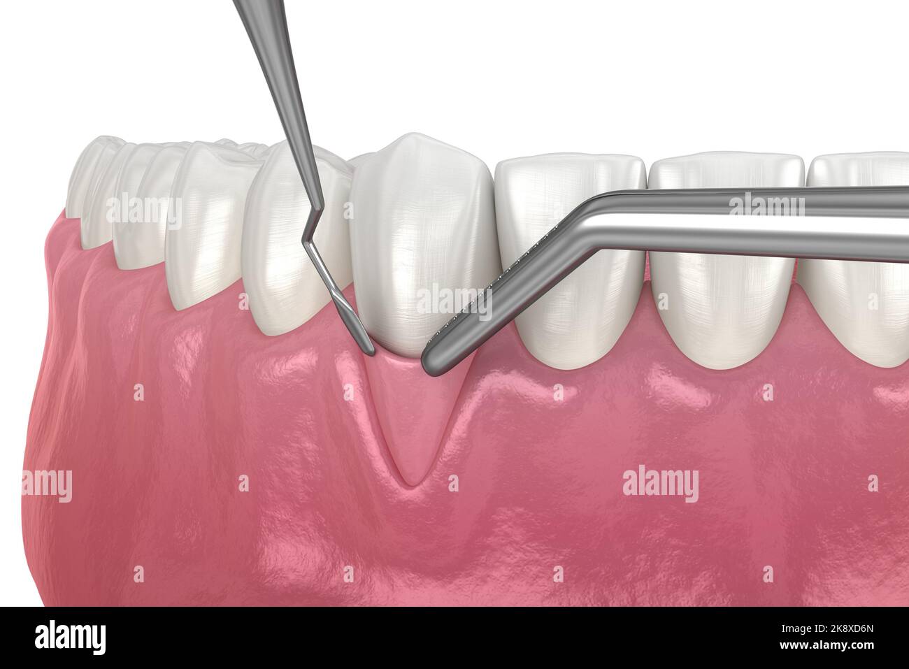 Gum Recession: Soft tissue graft surgery. 3D illustration of Dental ...