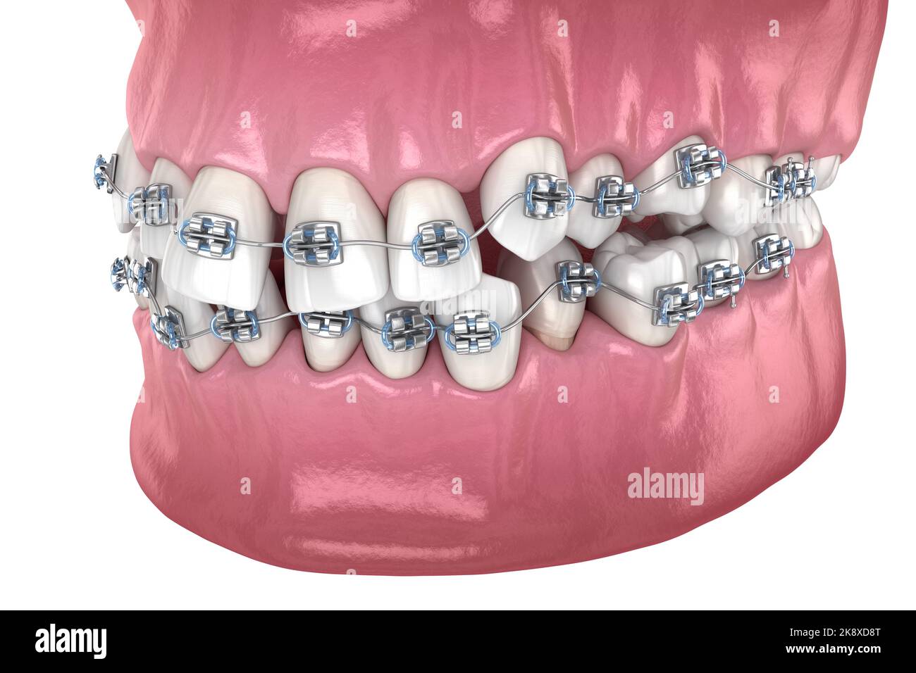 Abnormal teeth position and correction with metal braces tretament ...