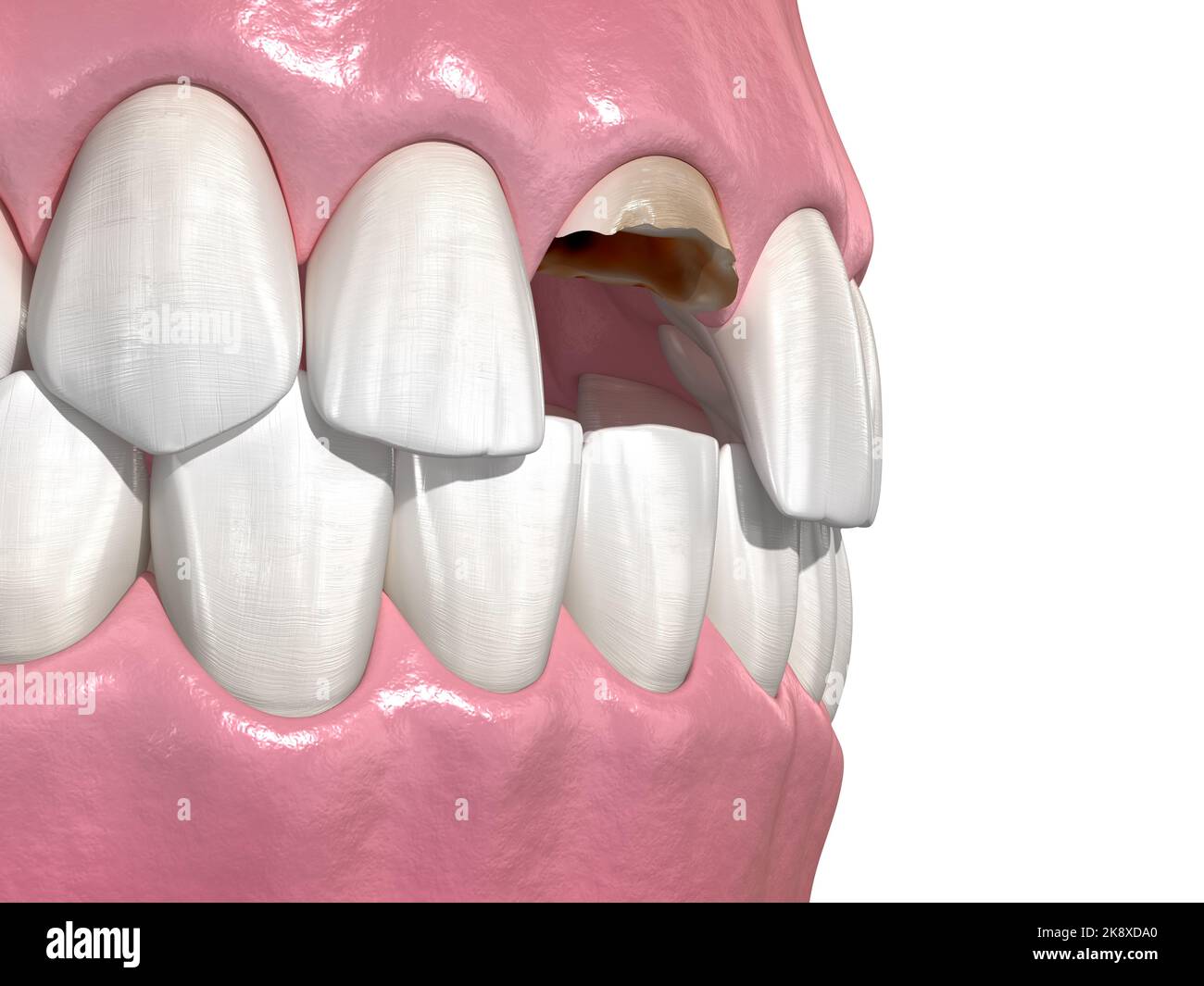 Broken central incisor tooth. Medically accurate 3D illustration of ...