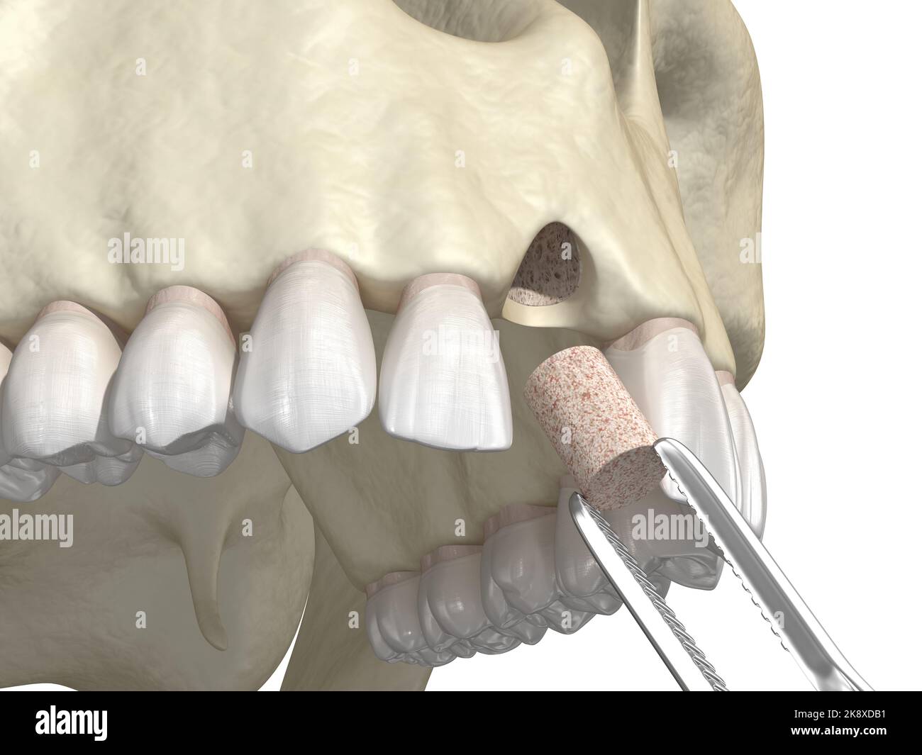 Bone grafting- augmentation using ring method, tooth implantation ...