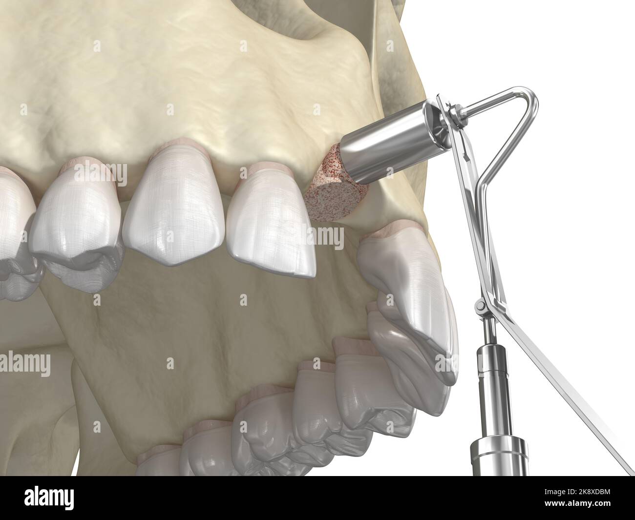 Bone grafting- augmentation using ring method, tooth implantation ... Bone grafting- augmentation using ring method, tooth implantation ...