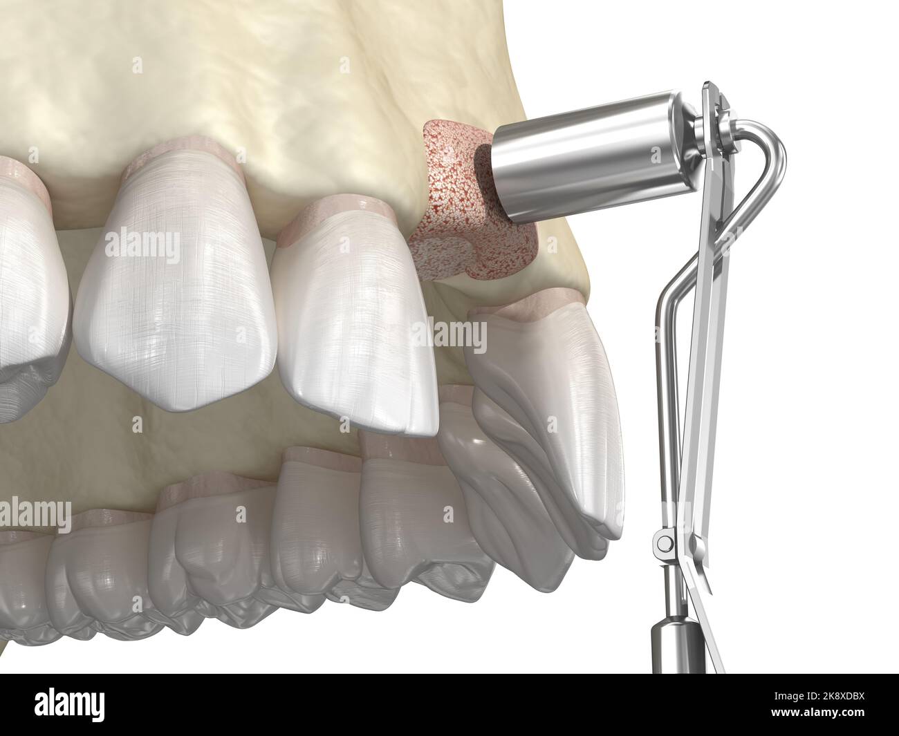 Bone grafting- augmentation using ring method, tooth implantation ...