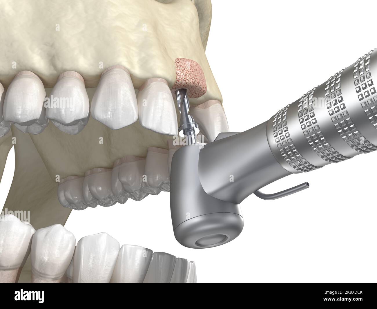 Bone grafting- augmentation using ring method, tooth implantation ... Bone grafting- augmentation using ring method, tooth implantation ...