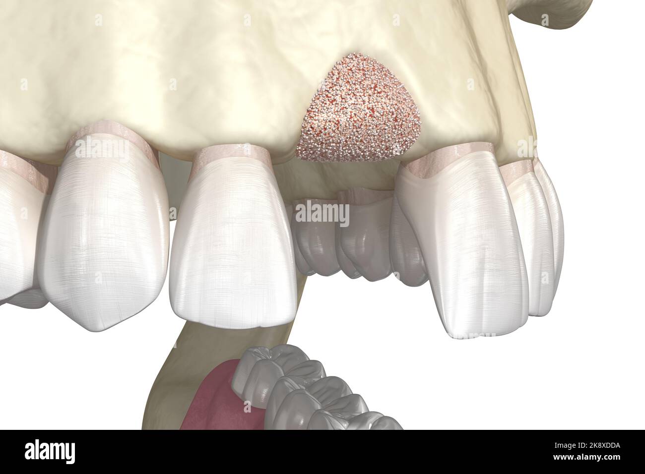 Augmentation Surgery - Adding bone after tooth extraction. 3D ...