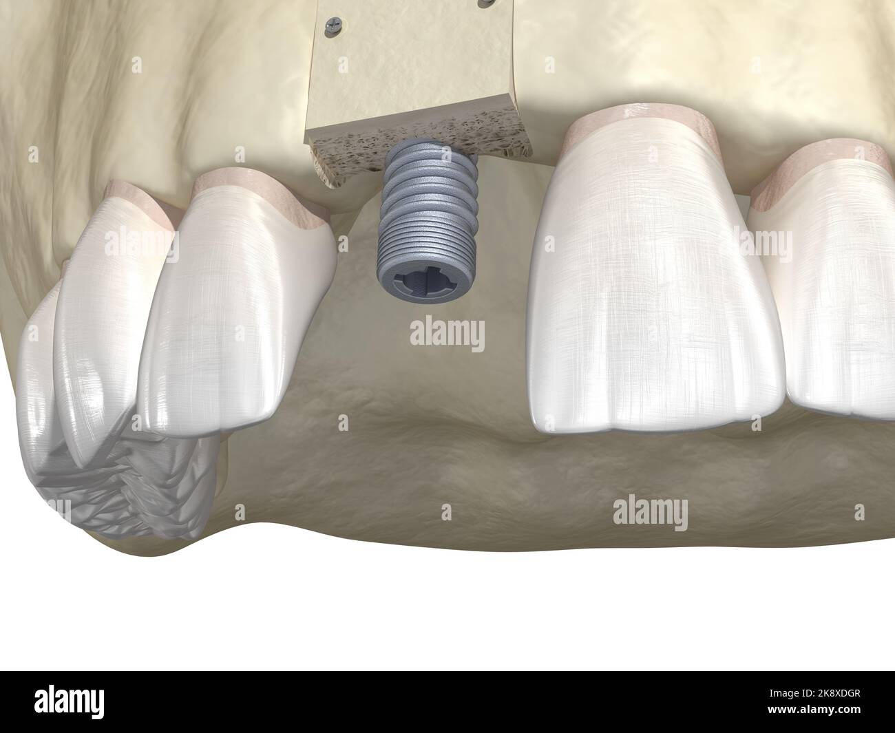 Bone grafting- augmentation using block of bone, tooth implantation ...