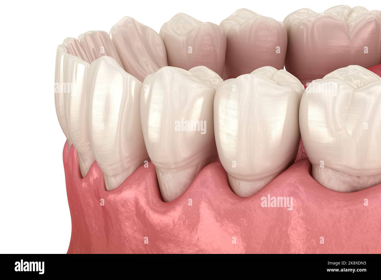 Gum recession process. Medically accurate 3D illustration Stock Photo ...