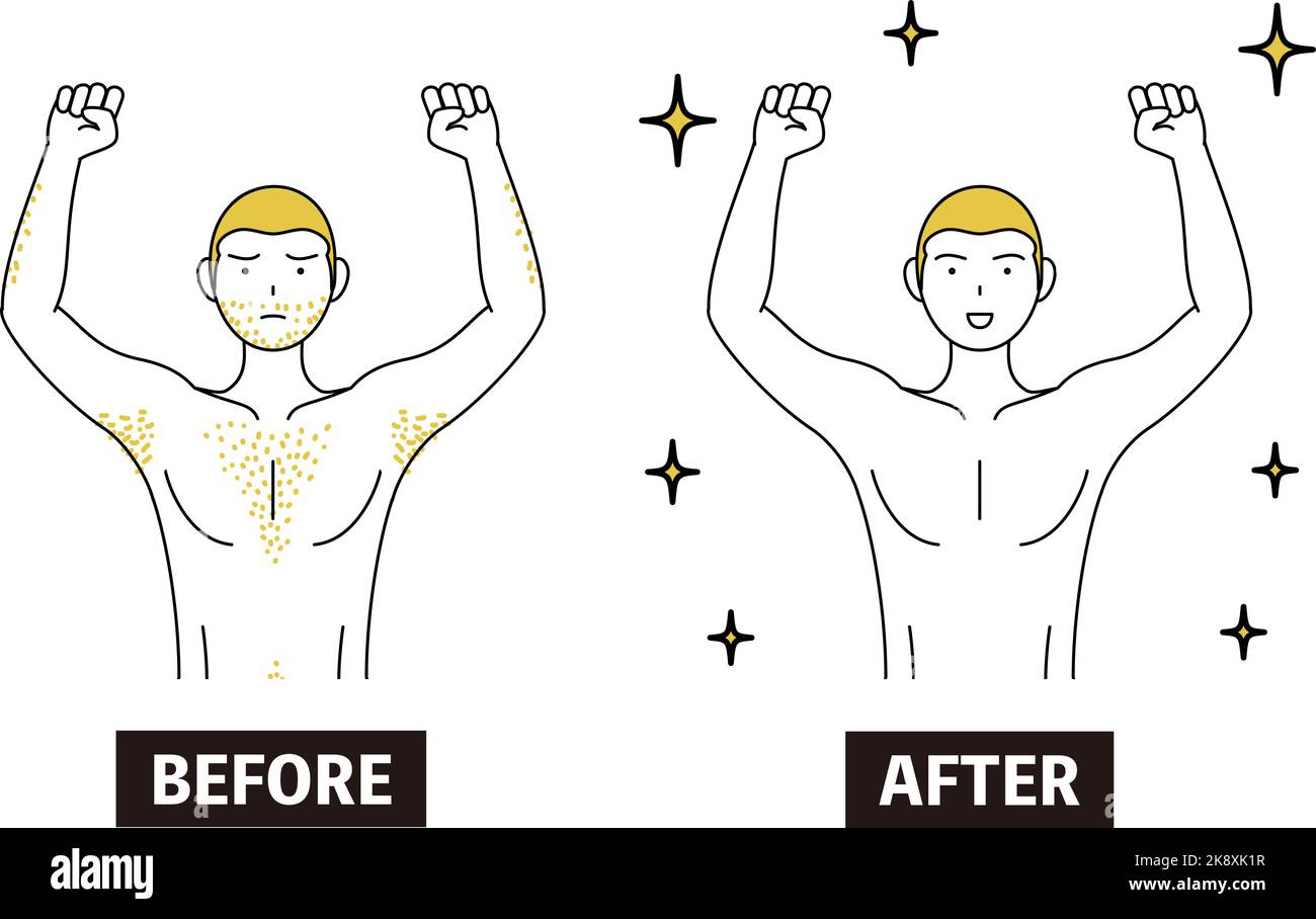 Image of medical hair removal, before-and-after of a man suffering from ...