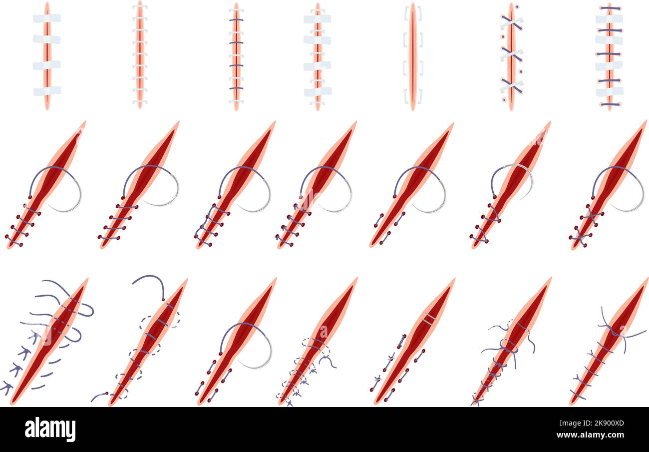 Suture icons set cartoon vector. Wound surgical Stock Vector Image & Art - Alamy