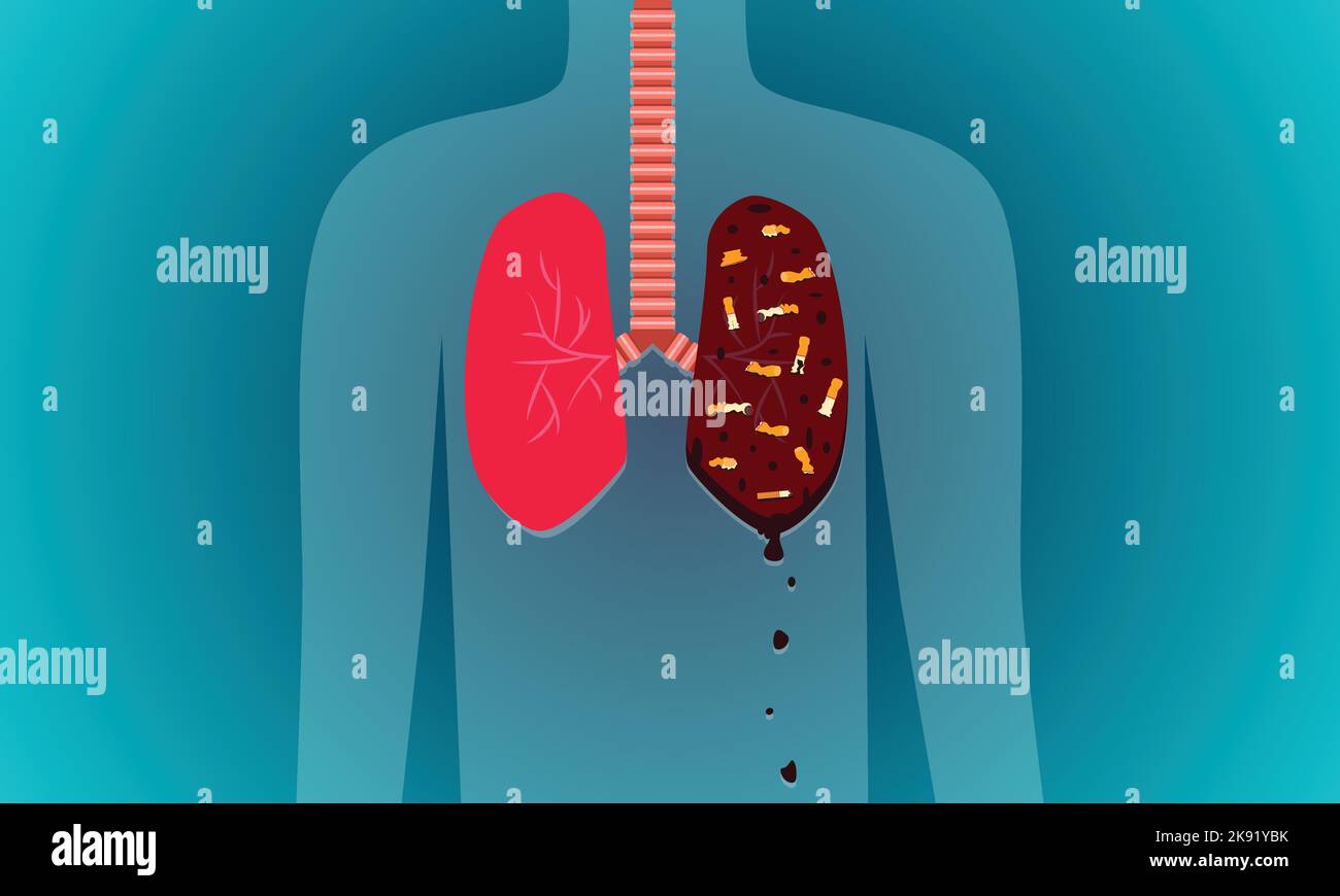 A vector of damaged lungs with cigarette smoke Stock Vector Image & Art ...