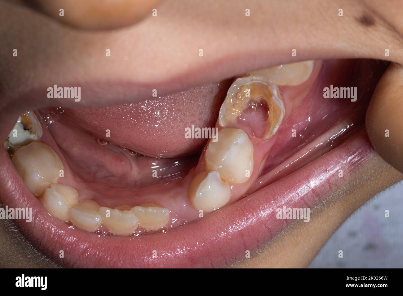 milk teeth caries, carious child teeth Stock Photo - Alamy