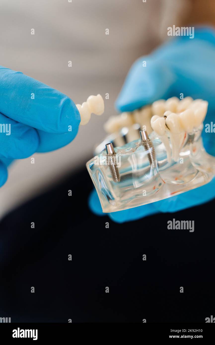 Artificial plastic jaw with dental implants close-up. Dental ...