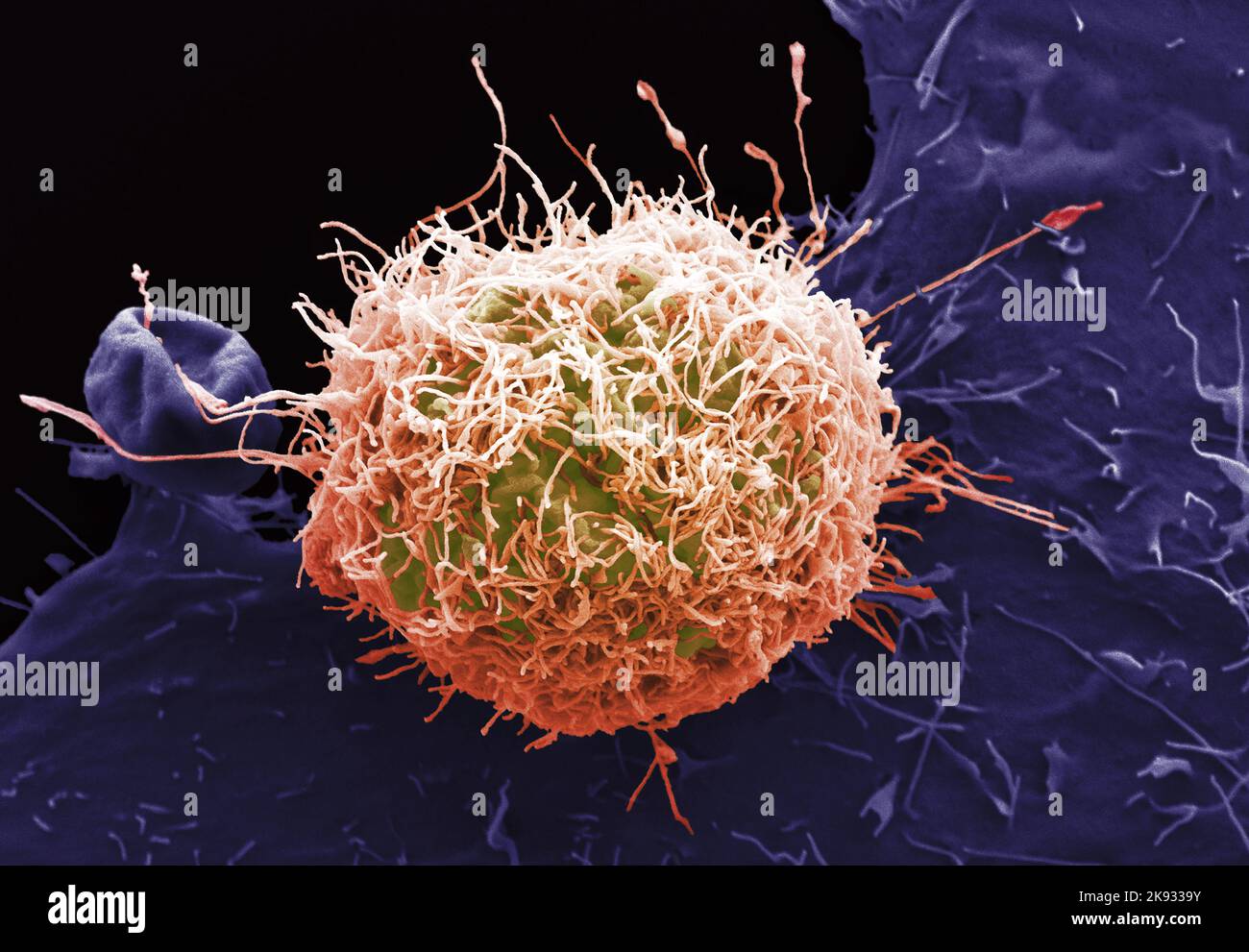 Cervical cancer cells, SEM Stock Photo - Alamy
