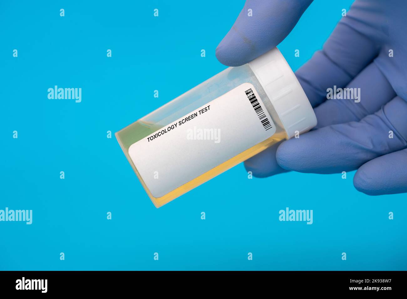 container with a urine sample for microbiological laboratory analysis ...