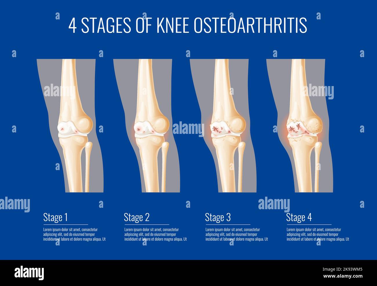 Knee Joint Osteoarthritis Stages Medical Infographics On Bone Cartilage Arthritis Vector Legs