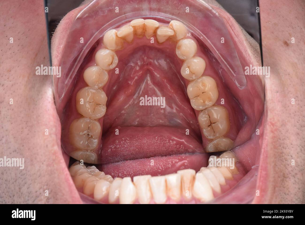 Close up camera picture teeth open mouth dentist examination before ...