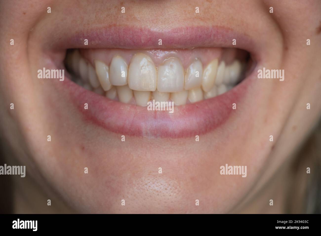 female teeth on a blurred background Stock Photo - Alamy