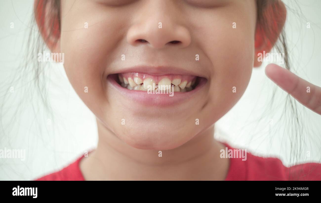 Happy Asian child in red showing her decayed teeth in selective focus ...