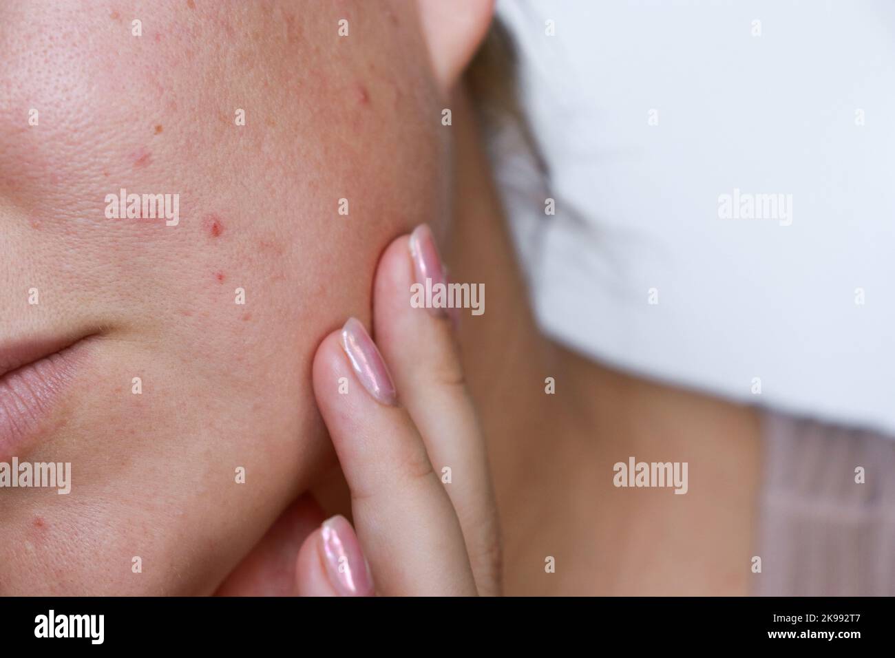 close up natural woman bad acne skin with scars Stock Photo - Alamy