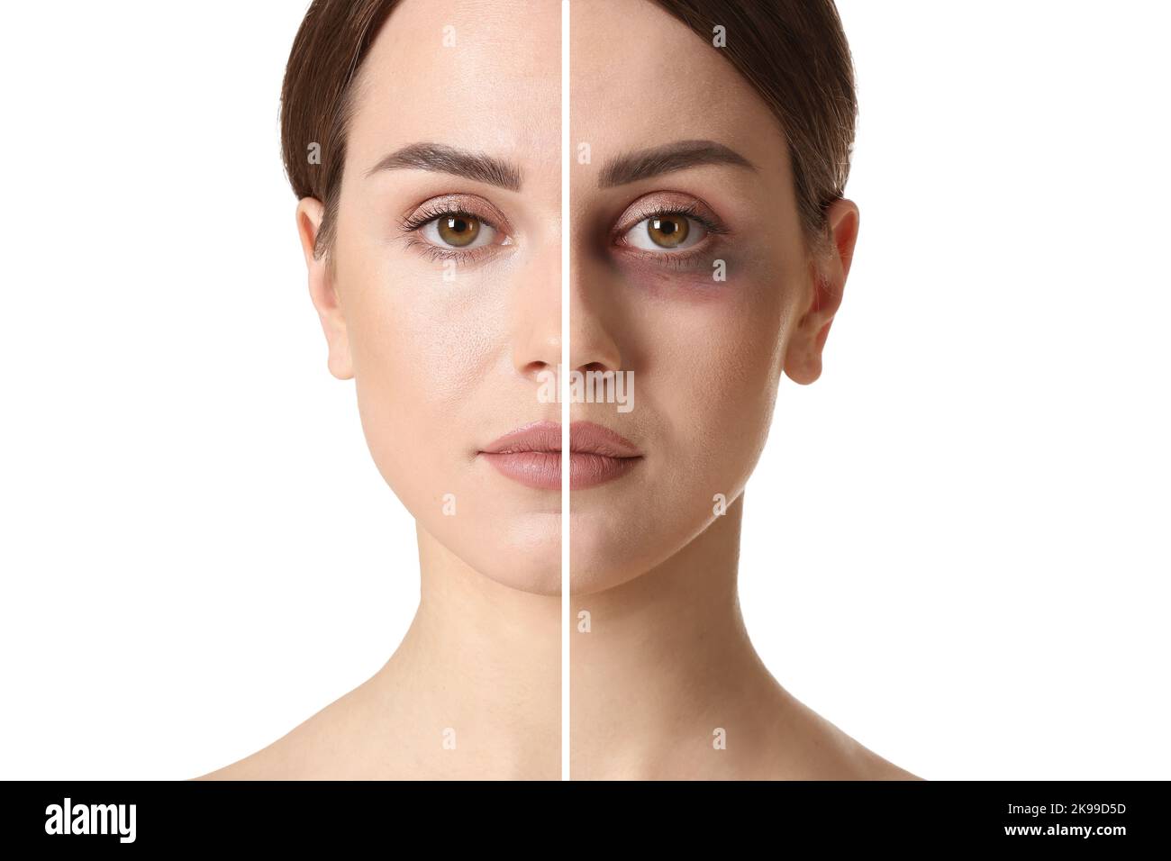 Face of young woman with and without bruise under eye on white ...