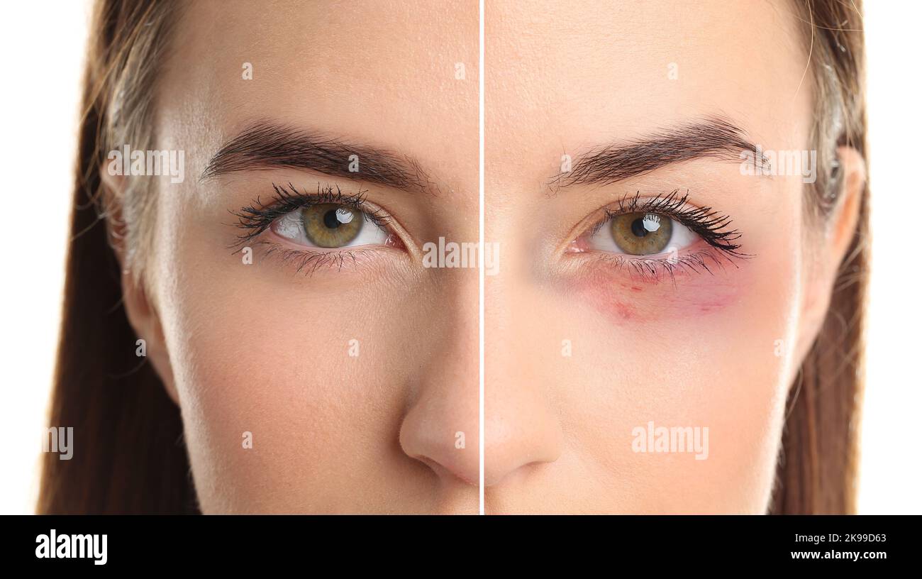 Face of young woman with and without bruise under eye on white ...