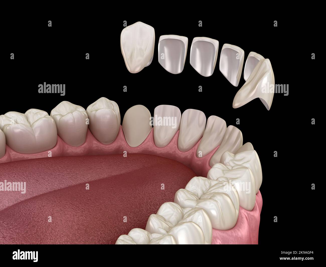 Veneer installation procedure over central incisor and lateral incisors ...