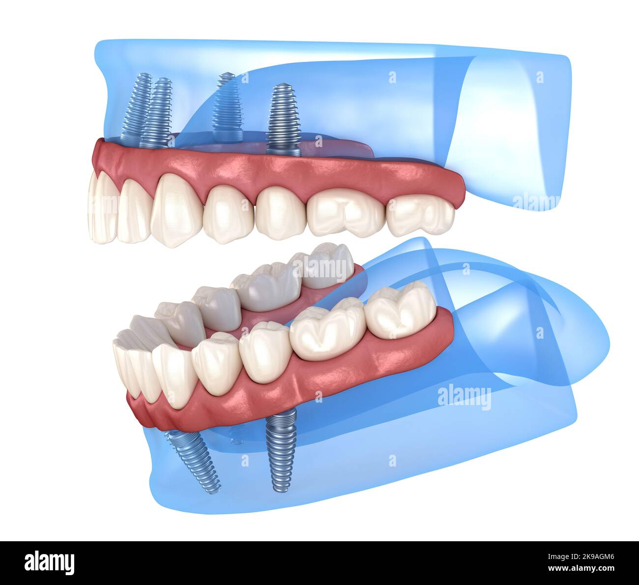 Maxillary and Mandibular prosthesis with gum All on 4 system supported ...