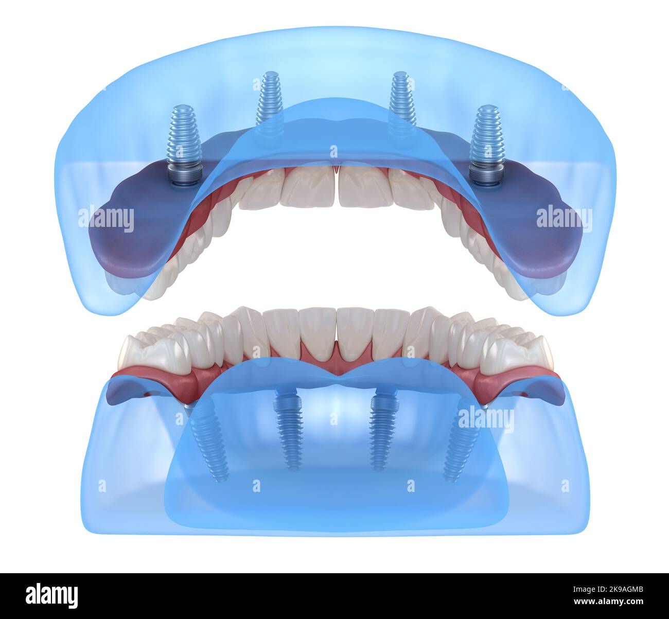 Maxillary and Mandibular prosthesis with gum All on 4 system supported ...