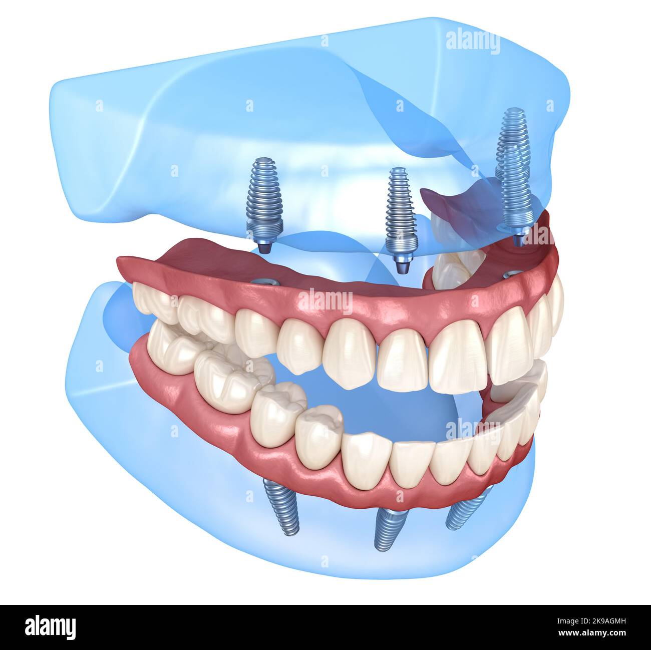 Maxillary and Mandibular prosthesis with gum All on 4 system supported ...