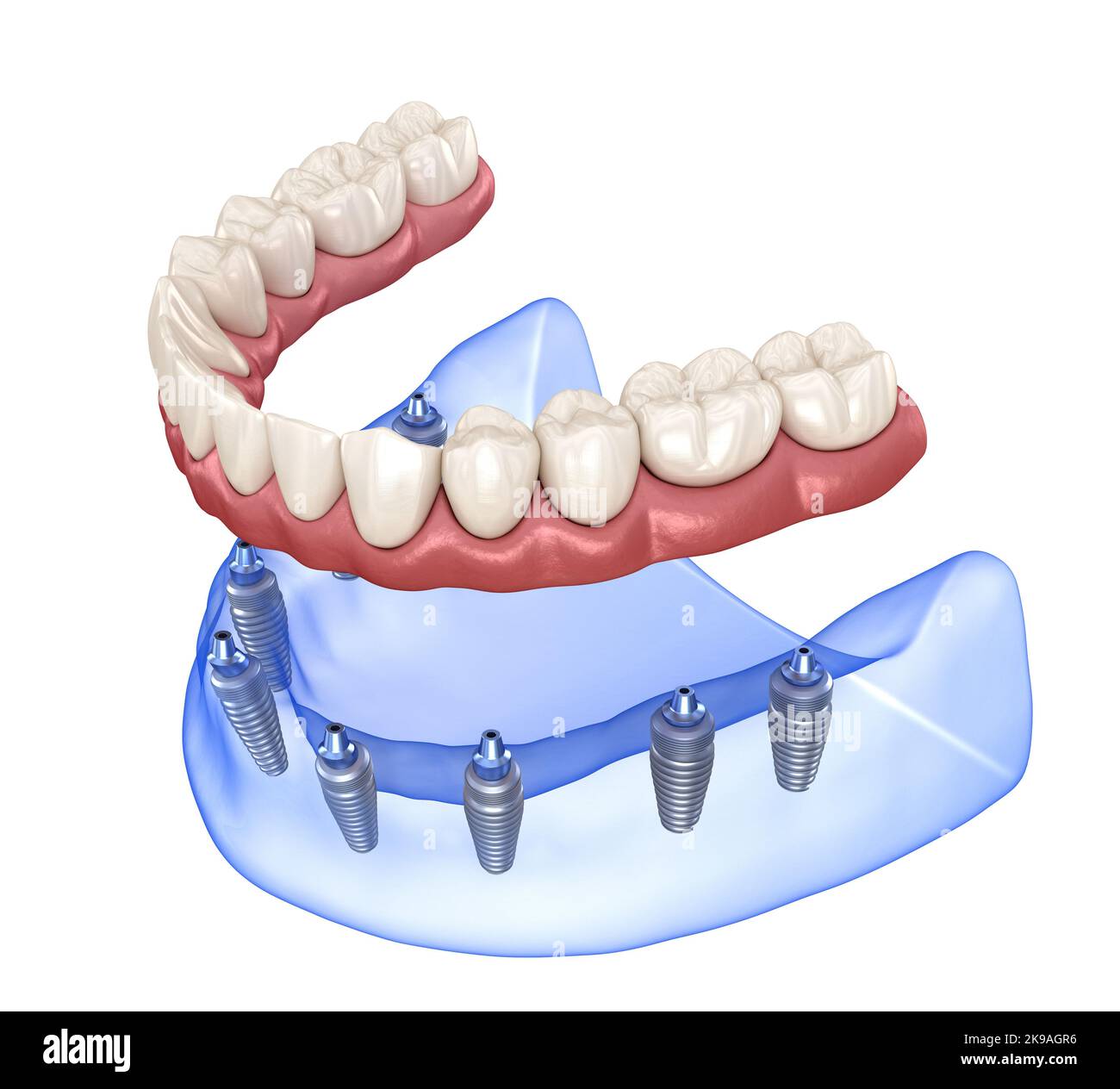 Maxillary and Mandibular prosthesis with gum All on 8 system supported ...