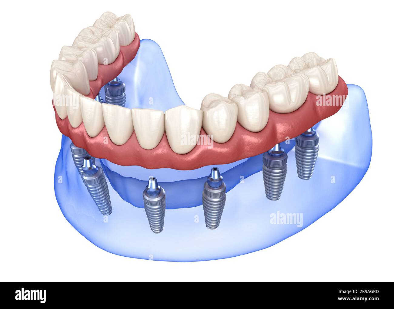 Maxillary and Mandibular prosthesis with gum All on 8 system supported ...