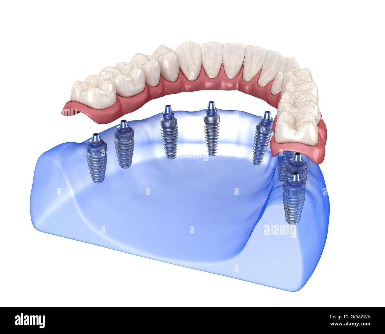 Maxillary and Mandibular prosthesis with gum All on 8 system supported ...