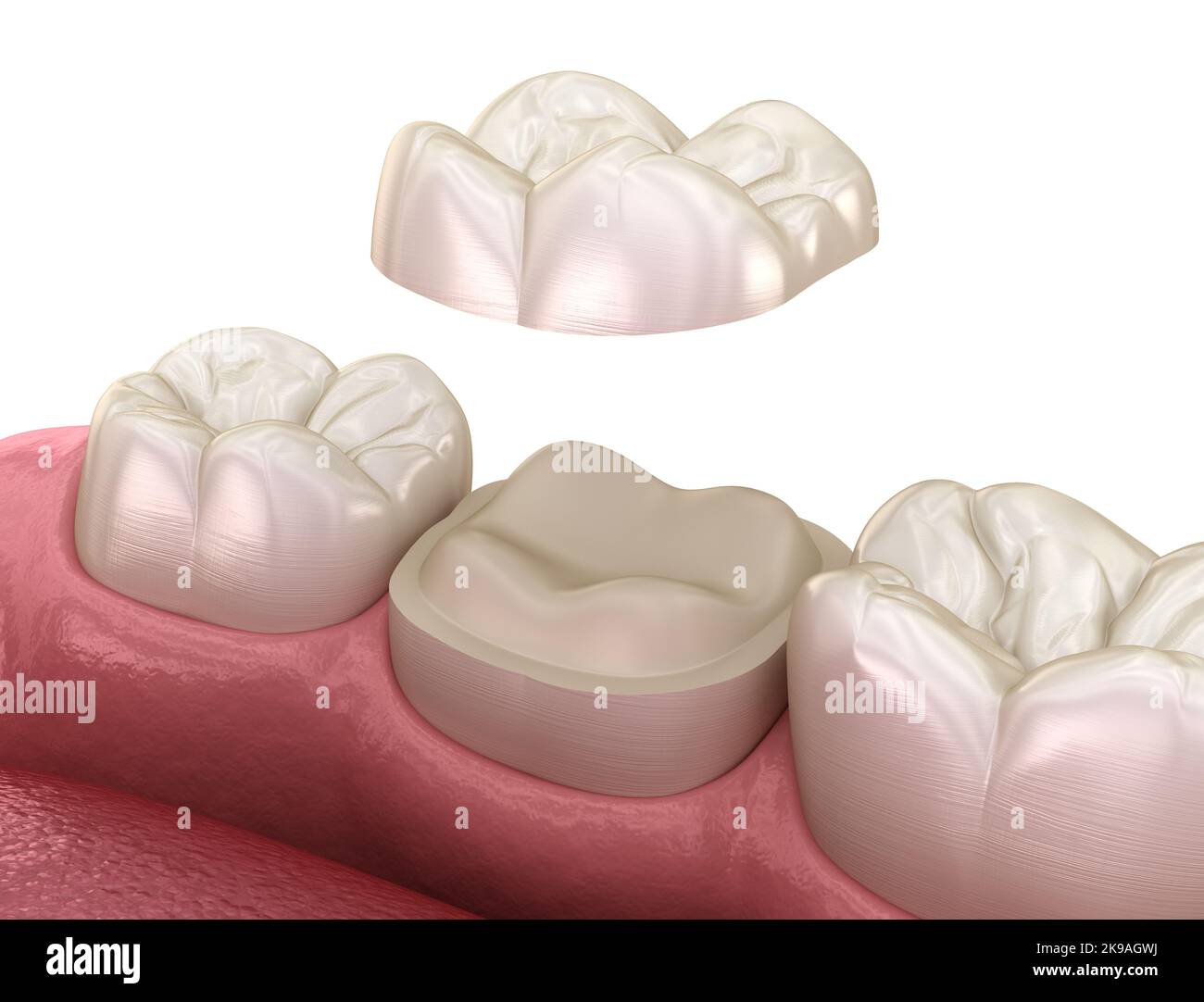 Onlay ceramic crown fixation over molar tooth. Medically accurate 3D ...