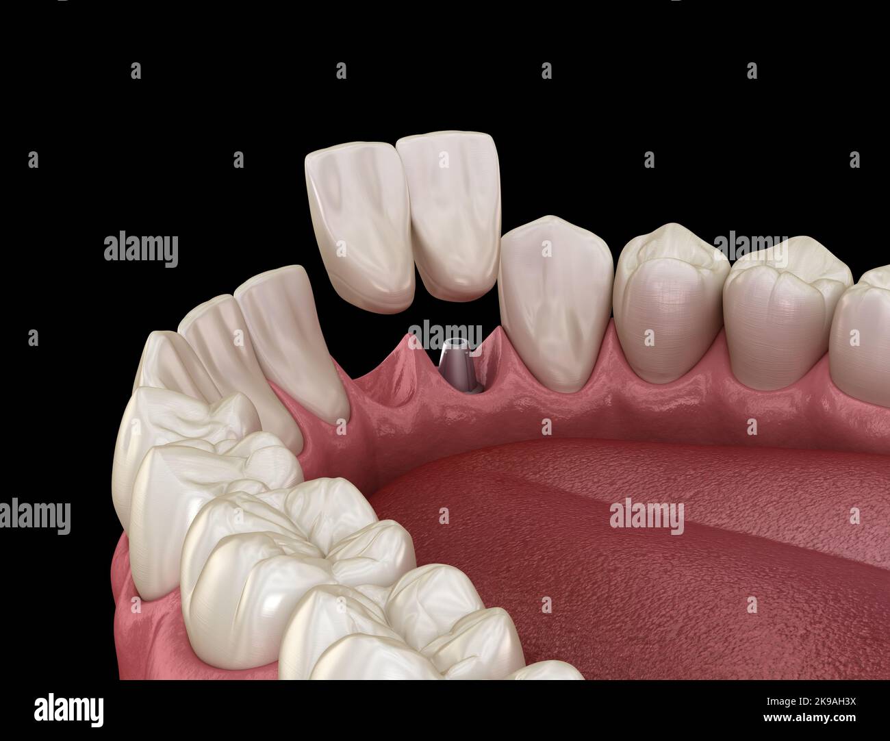 Cantilever bridge implant based, frontal tooth recovery. Medically ...