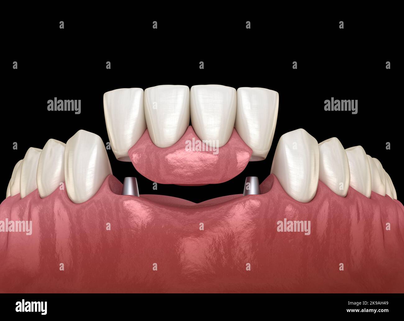 Frontal teeth bridge supported by implants. Medically accurate 3D ...
