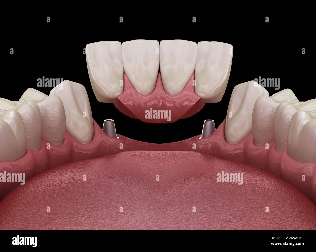 Frontal teeth bridge supported by implants. Medically accurate 3D ...