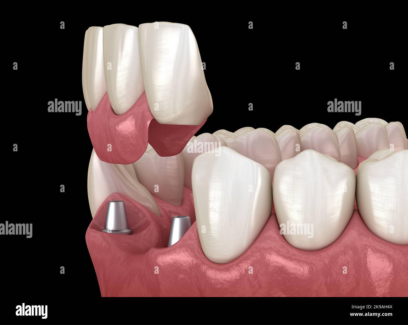 Frontal teeth bridge supported by implants. Medically accurate 3D ...