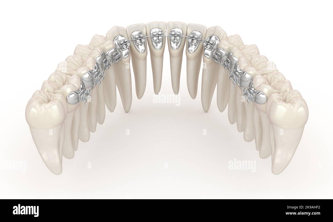 Lingual braces system. 3D illustration concept of silver braces Stock ...