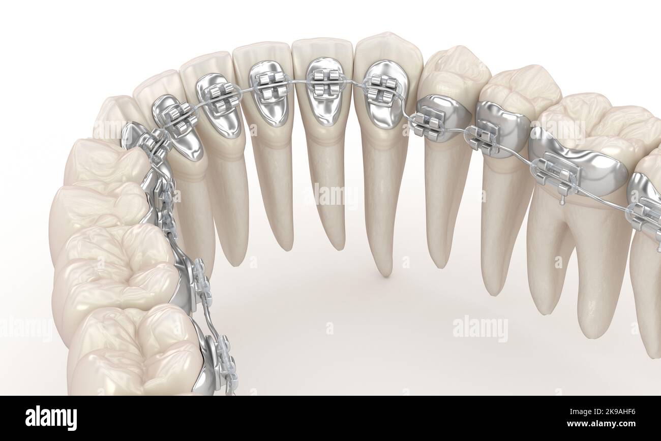 Lingual braces system. 3D illustration concept of silver braces Stock ...
