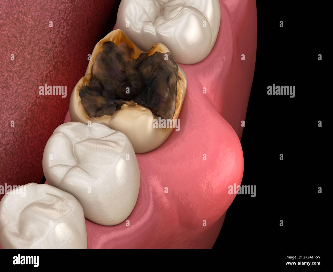 Periodontitis and gum inflammation. Medically accurate dental 3D ...