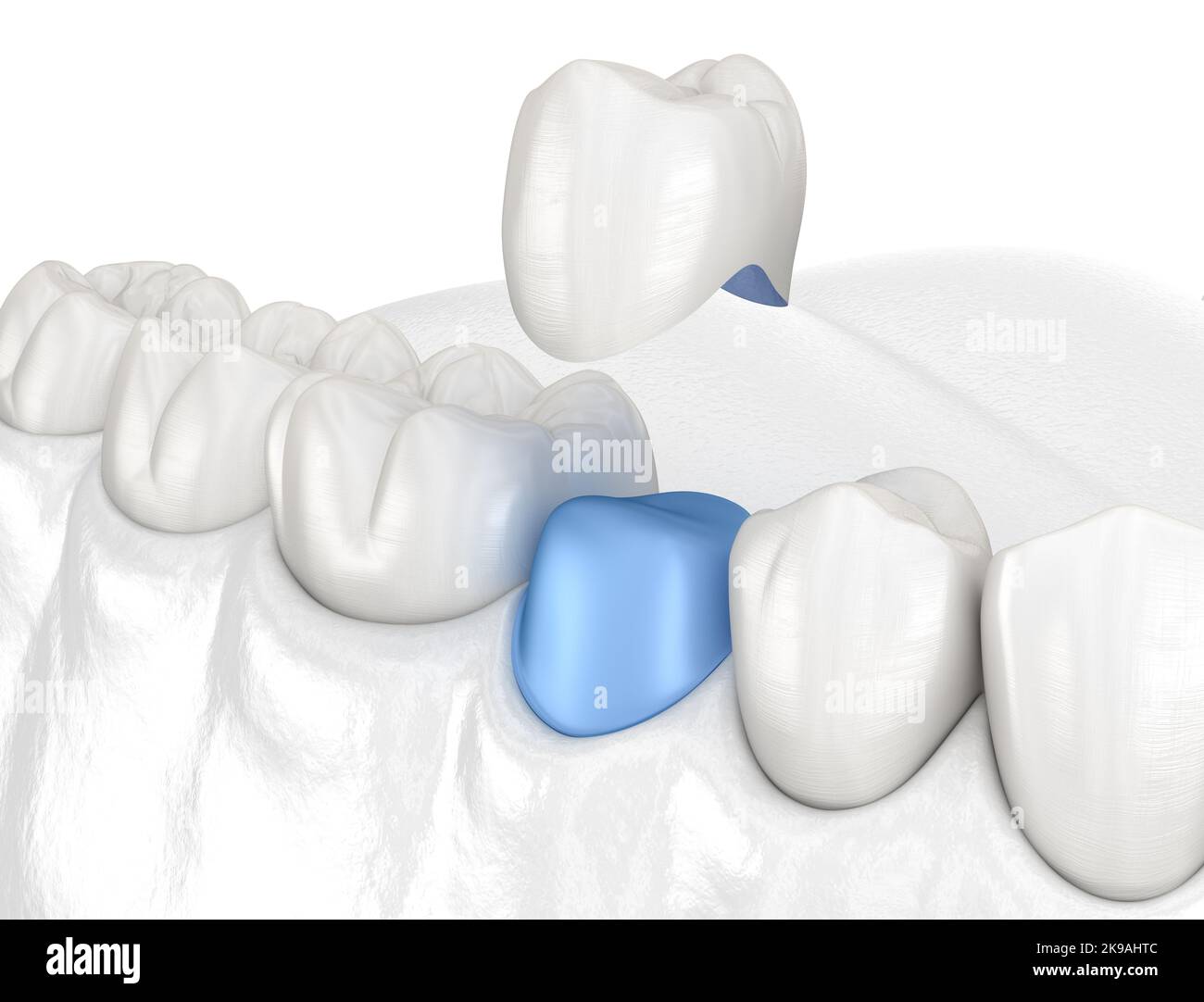 Porcelain crown placement over premolar tooth. Medically accurate 3D ...