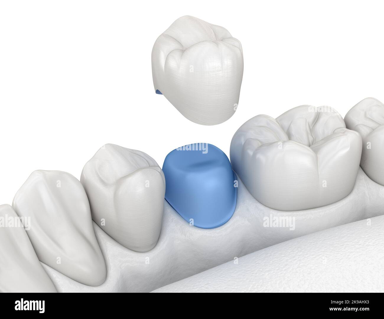 Porcelain crown placement over premolar tooth. Medically accurate 3D ...